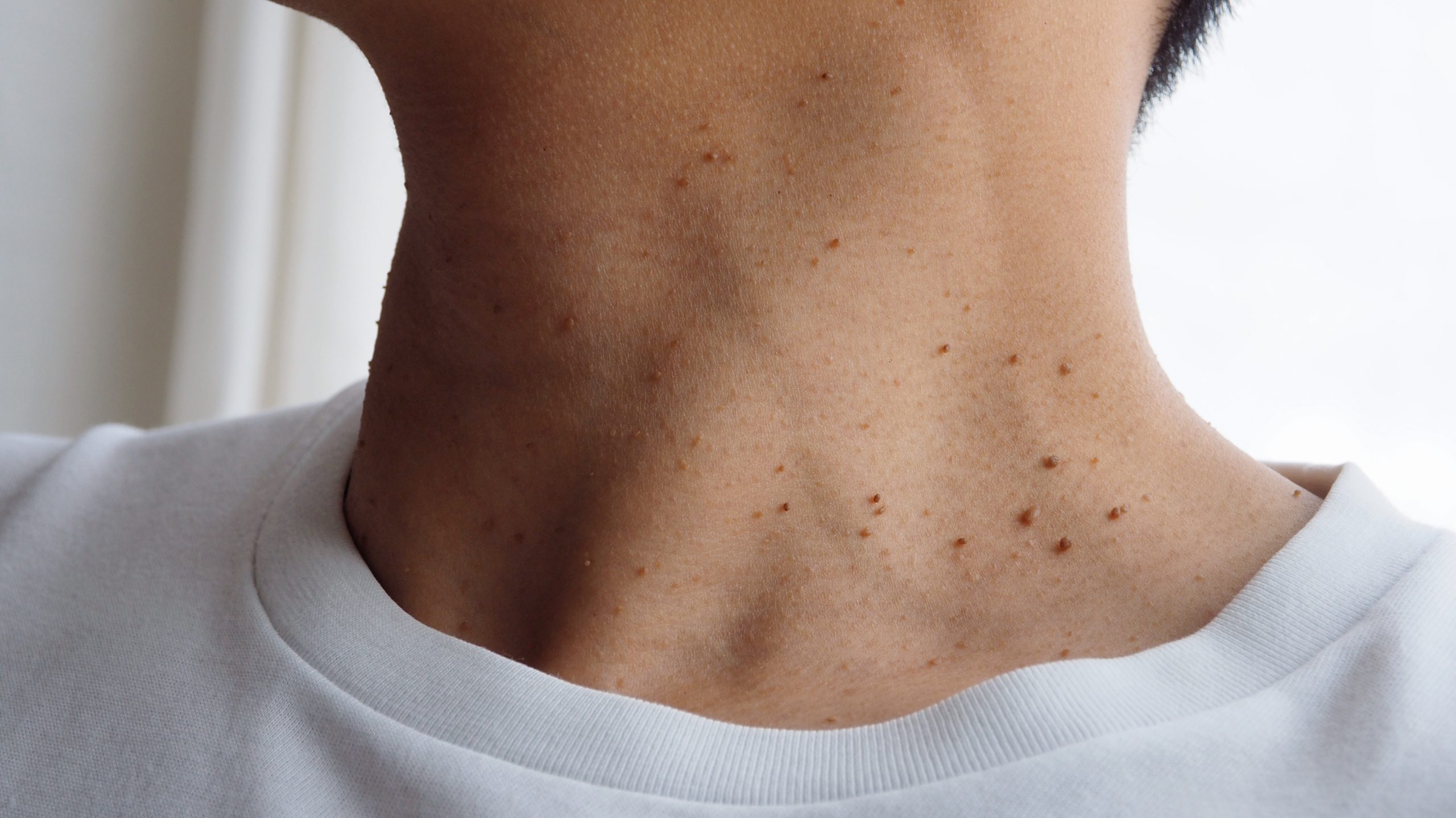 Skin Tags On Neck